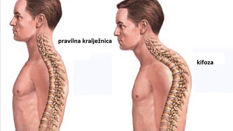 KIFOZA – FizioCentar PROSpine